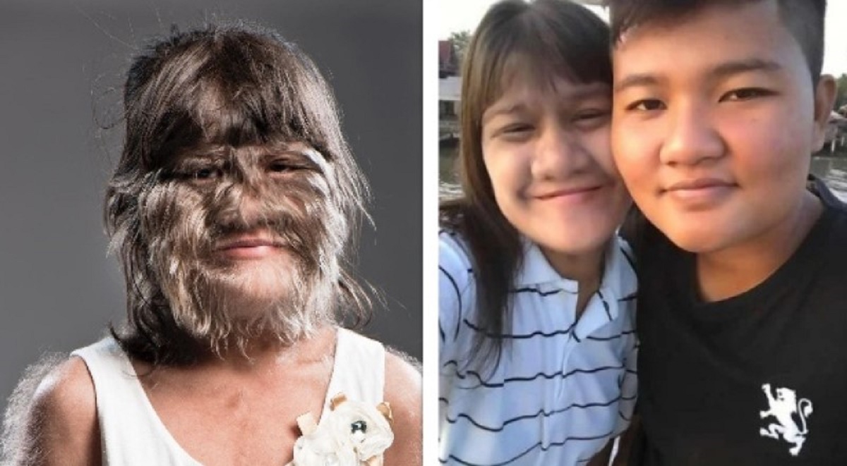 השינוי המדהים של הילדה הכי שעירה בעולם שסובלת ממחלה נדירה - Twoday טודיי